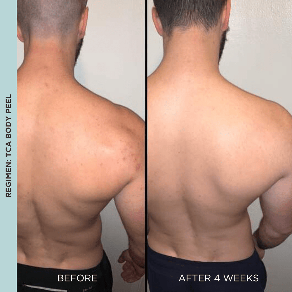 TCA Body Peel for Keratosis Pilaris (KP) & Body Acne